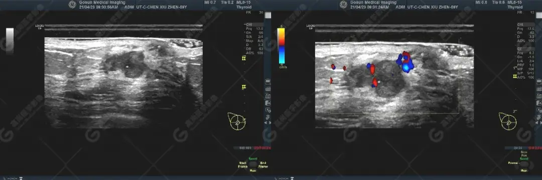 Breast cancer science: Paget disease of the nipple (eczematoid cancer ...