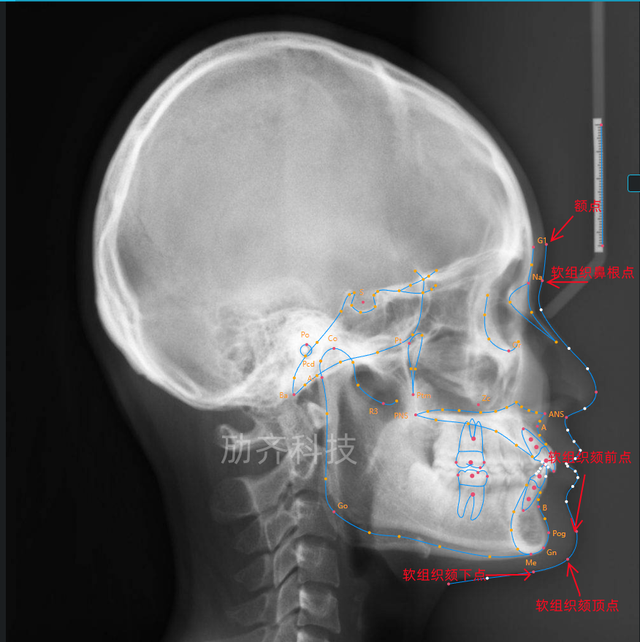 【劢齐科技】头影测量-常用软组织标志点及平面-劢齐科技的博客-KQ88口腔博客